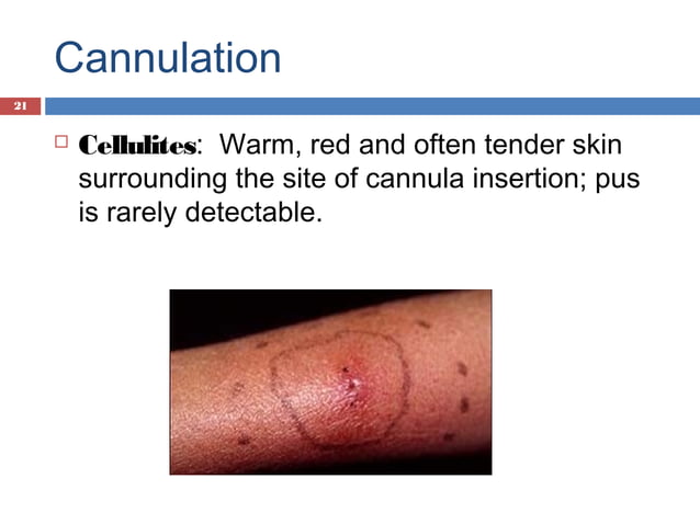 Intravenous cannulation | PPT | First Aid | Injuries