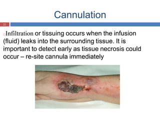 INTRAVENOUS CANNULATION INTRAVENOUS CANNULATION | PPT