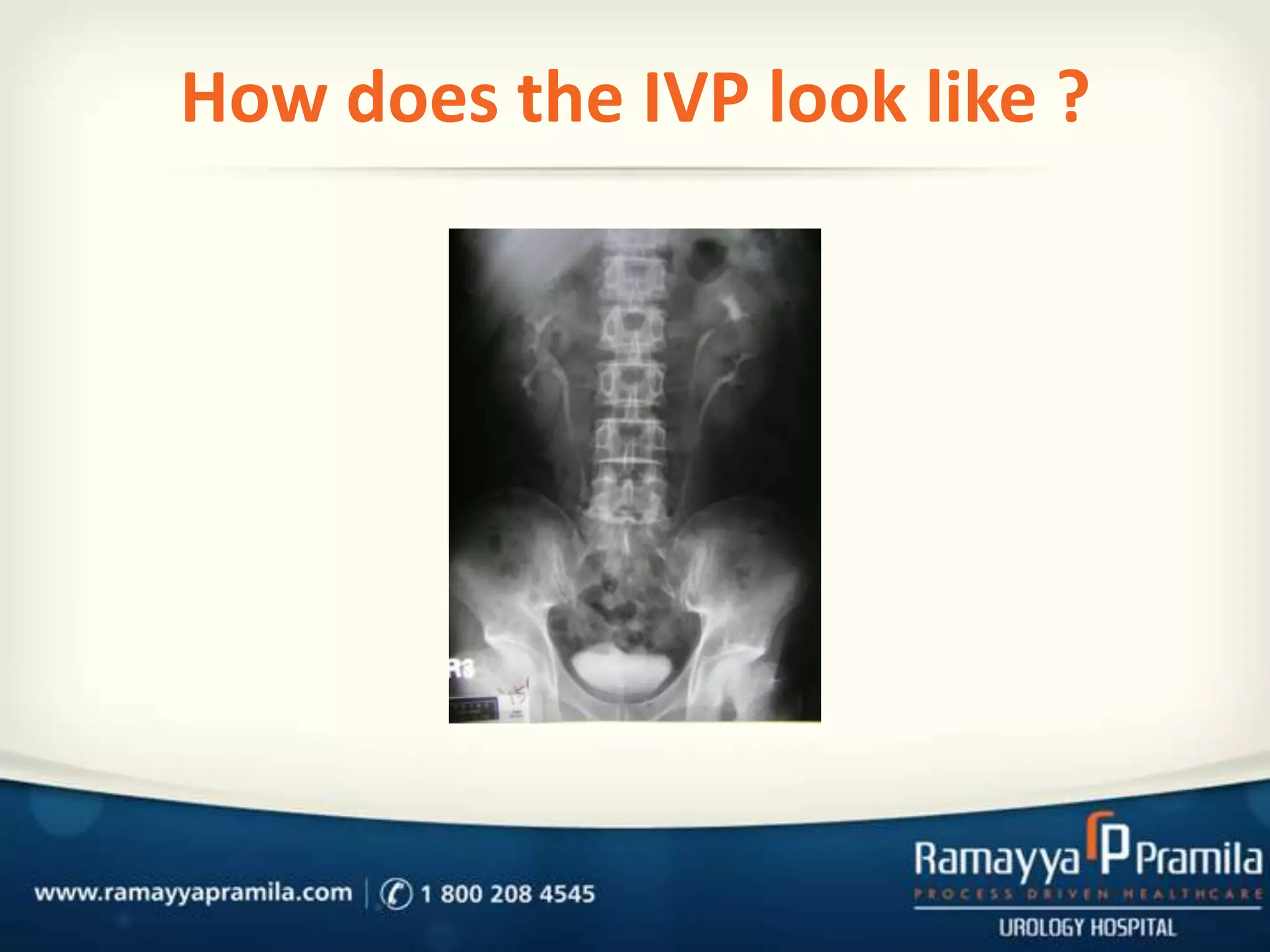 Intravenous pyelogram | PPTX
