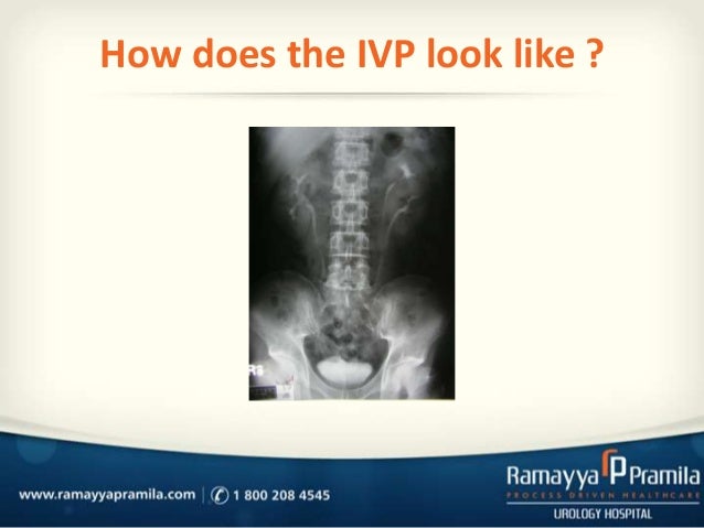 Intravenous Pyelogram