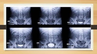 intravenous pylogram (IVP/IVU) intravenous urogram | PPTX