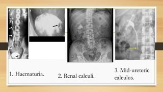 intravenous pylogram (IVP/IVU) intravenous urogram | PPTX