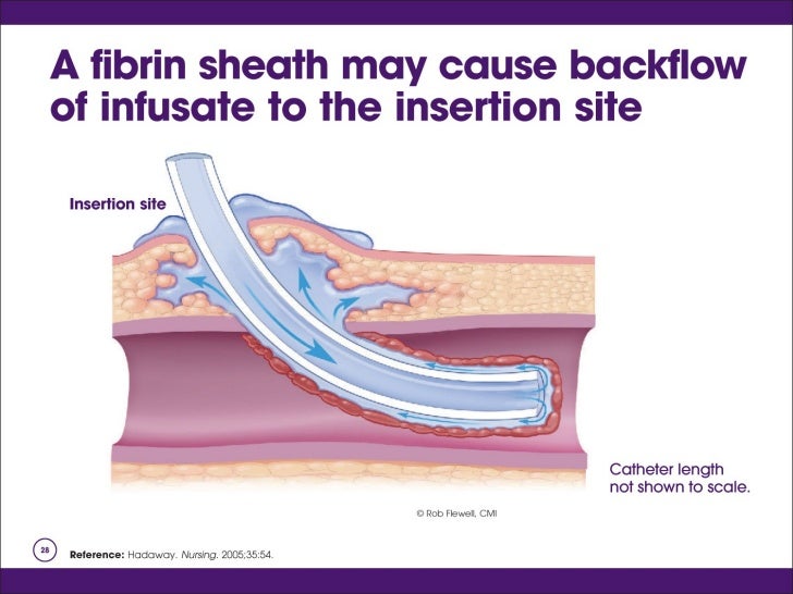 Intra venous therapy complications
