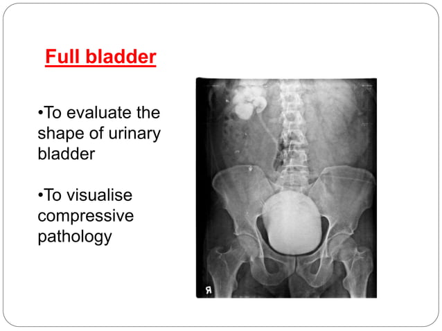 Intravenous urogram ( Sandip Gautam ) | PPTX