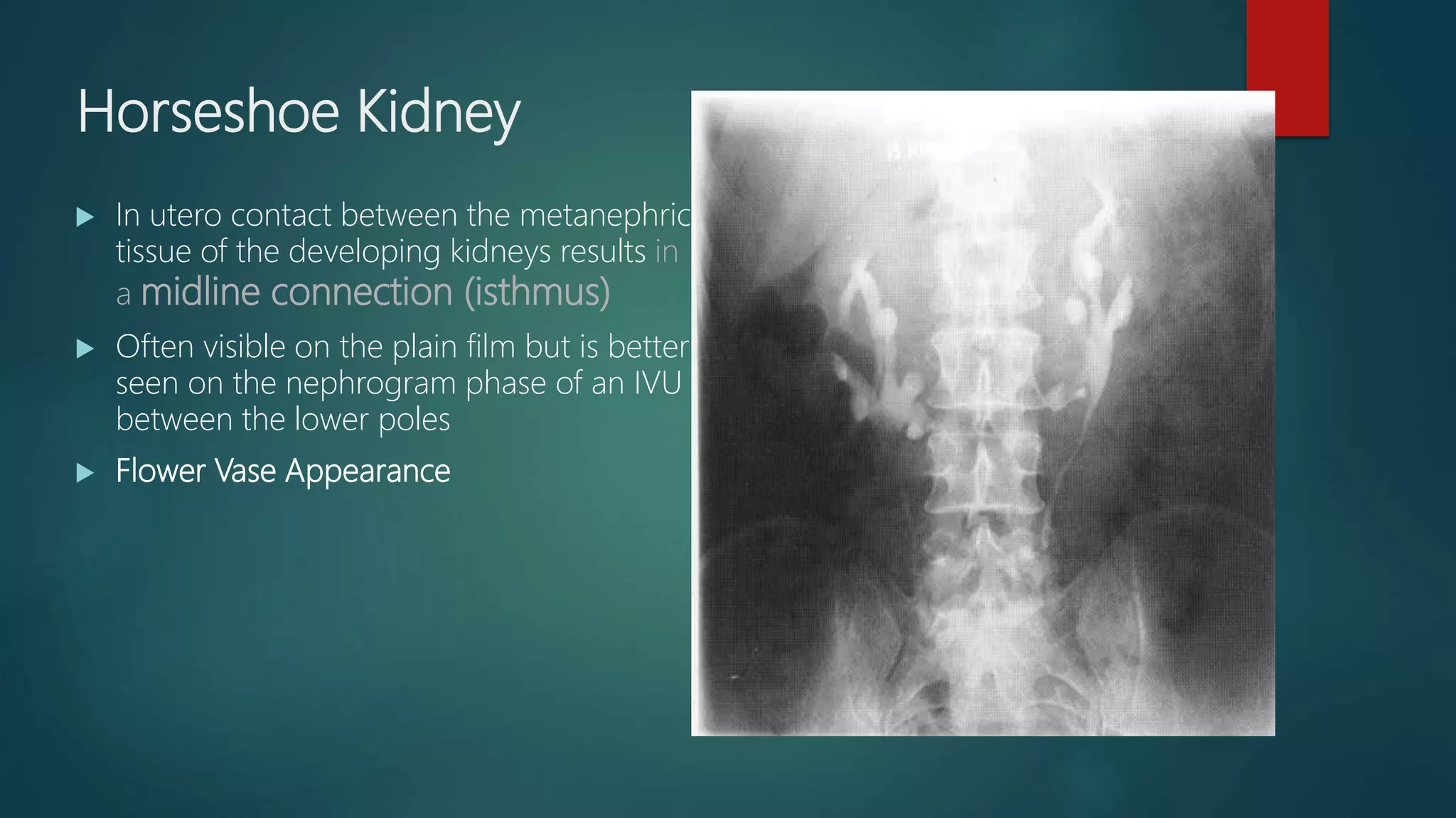 Intravenous urography | PPT
