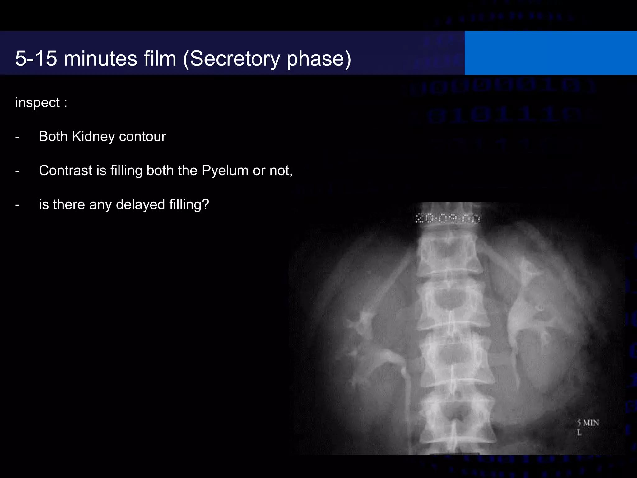 Intravenous urography (IVU) | PDF