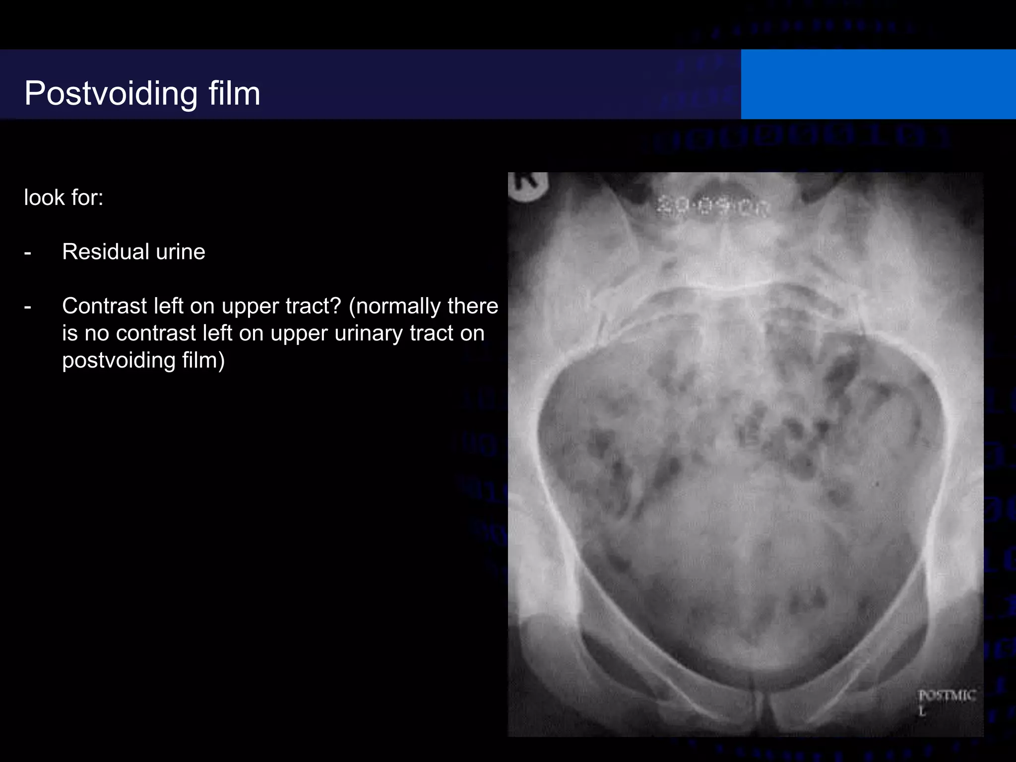 Intravenous urography (IVU) | PDF