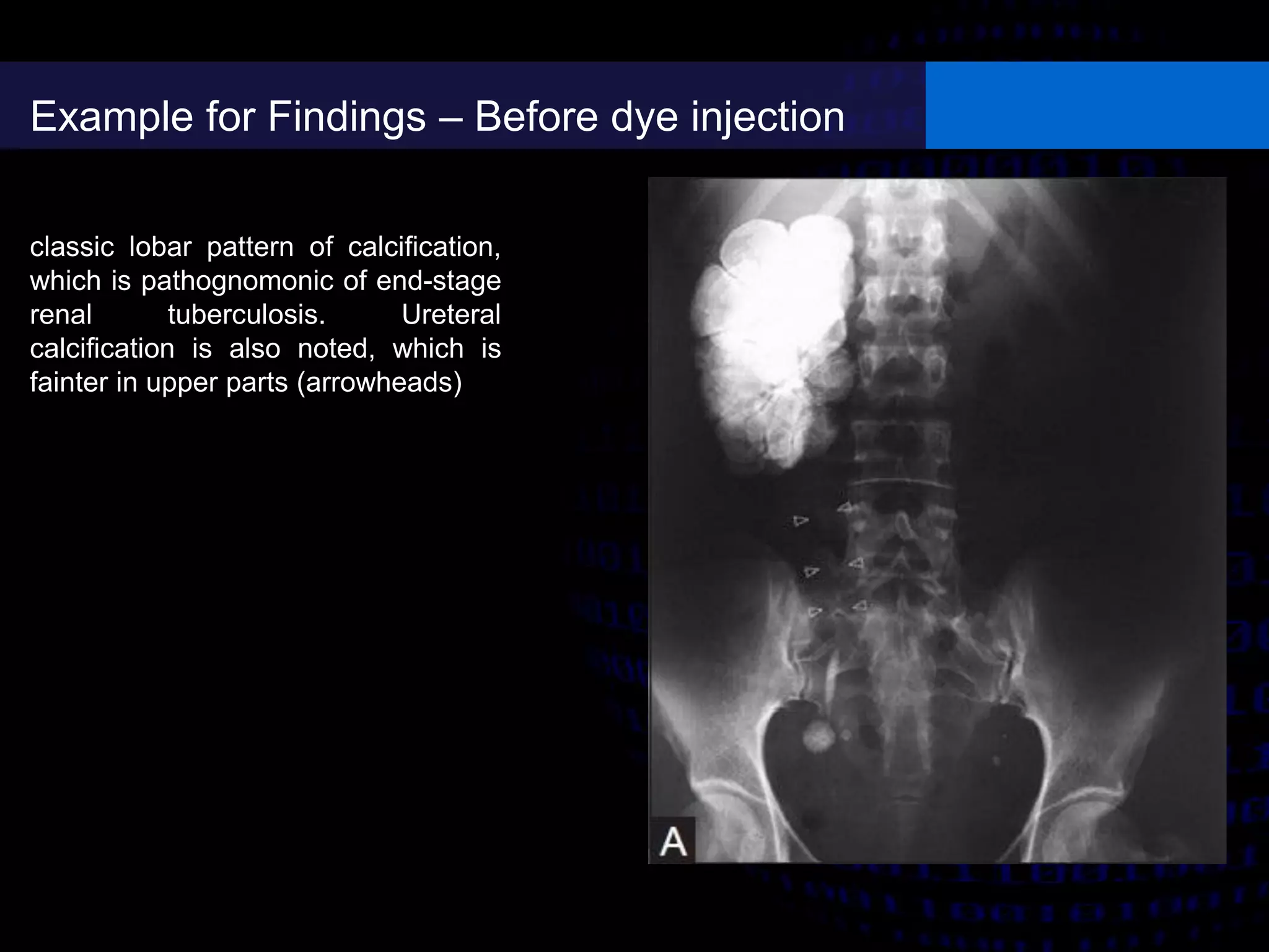 Intravenous urography (IVU) | PDF