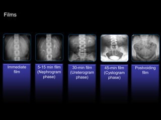 Intravenous urography (IVU) | PDF