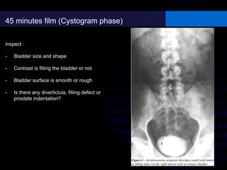 Intravenous urography (IVU) | PDF