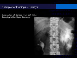 Kidney X Ray With Dye