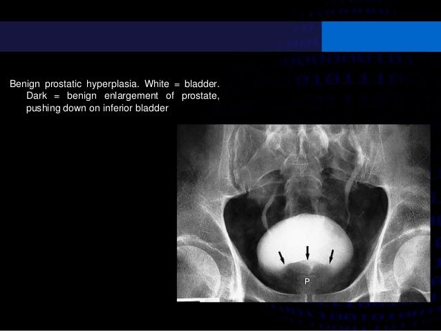 Intravenous urography (IVU)