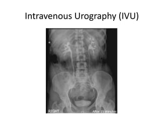 Intravenous Urography (IVU)., radiological procedure | PPTX