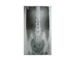 Intravenous Urography (IVU)., radiological procedure | PPTX