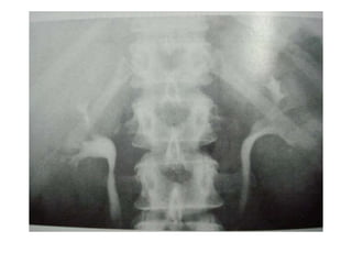 Intravenous Urography (IVU)., radiological procedure | PPTX