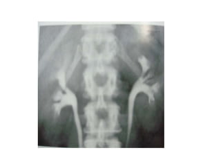 Intravenous Urography (IVU)., radiological procedure | PPTX