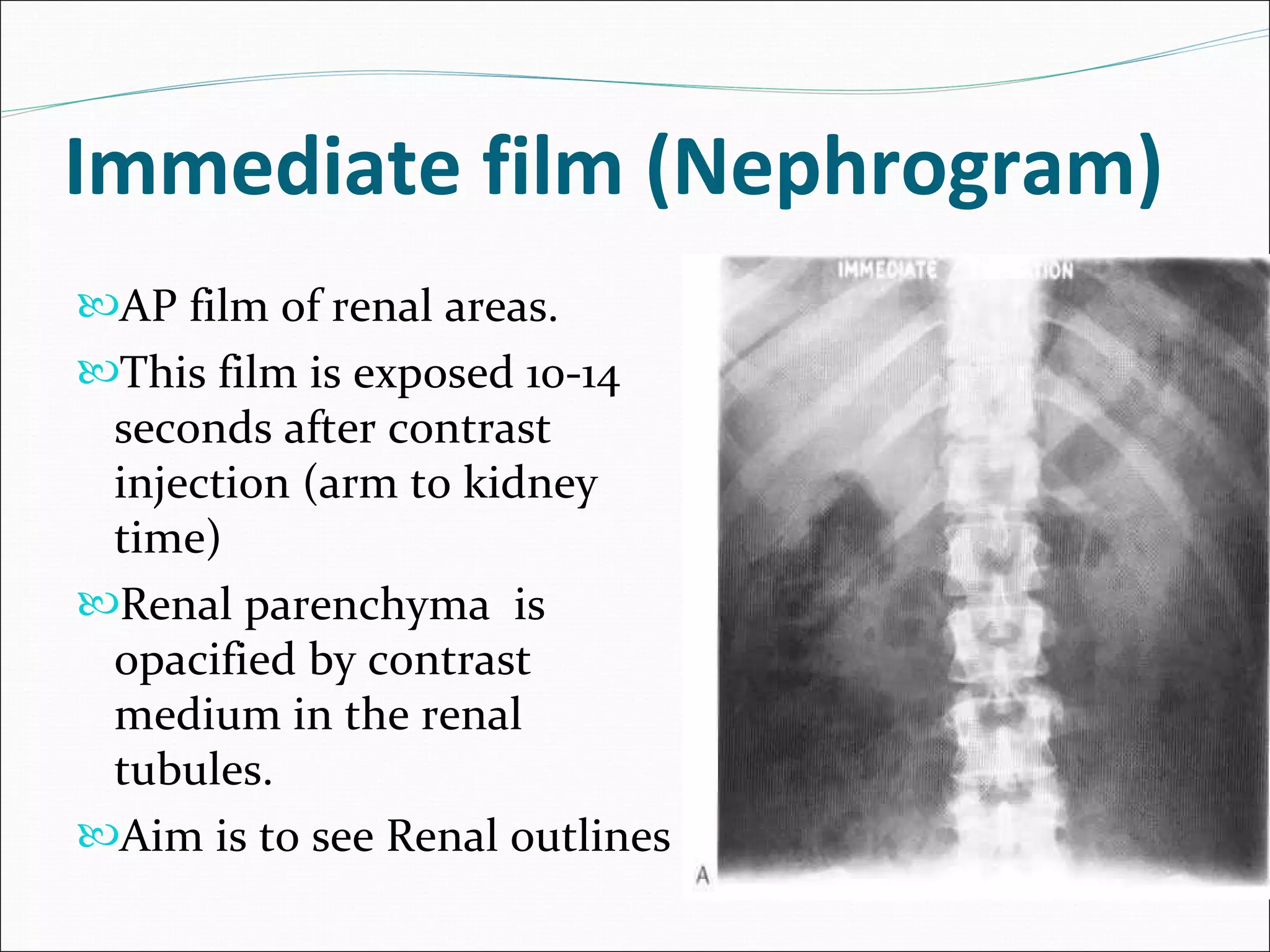 Intravenous urography (IVU) by Dr Bishnu Khatiwada, Conventional IVU ...