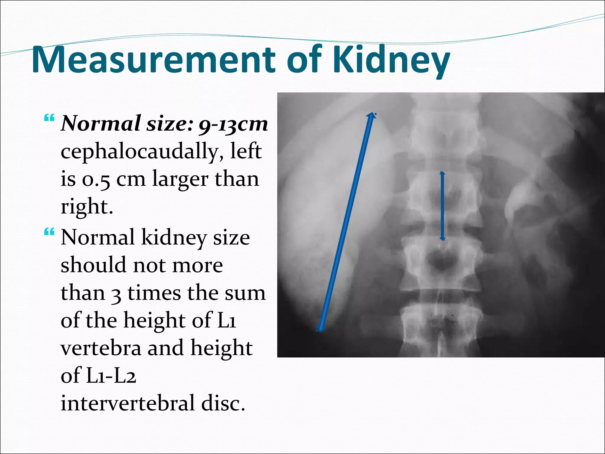 Intravenous urography (IVU) by Dr Bishnu Khatiwada, Conventional IVU ...