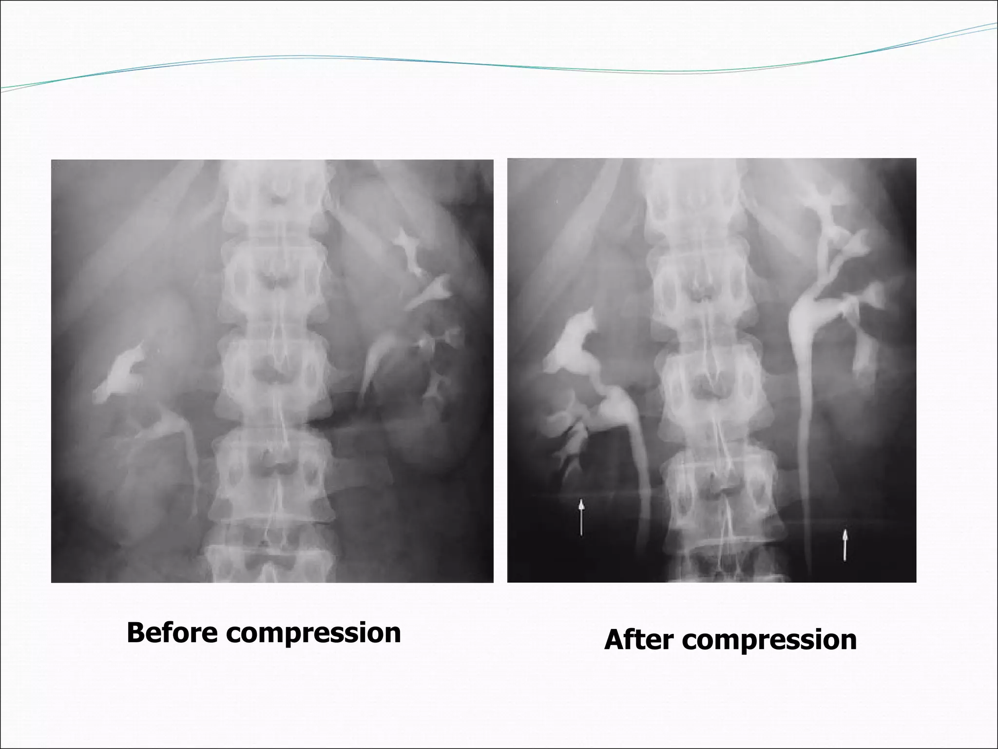 Intravenous urography (IVU) by Dr Bishnu Khatiwada, Conventional IVU ...