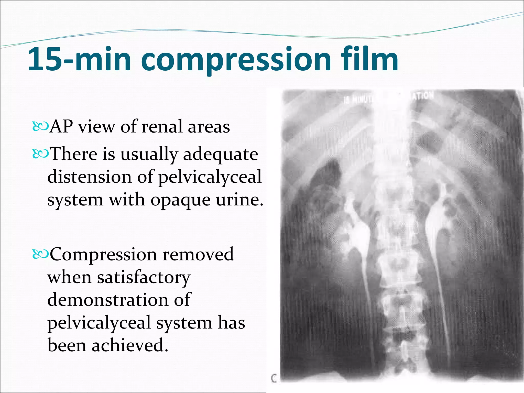 Intravenous urography (IVU) by Dr Bishnu Khatiwada, Conventional IVU ...