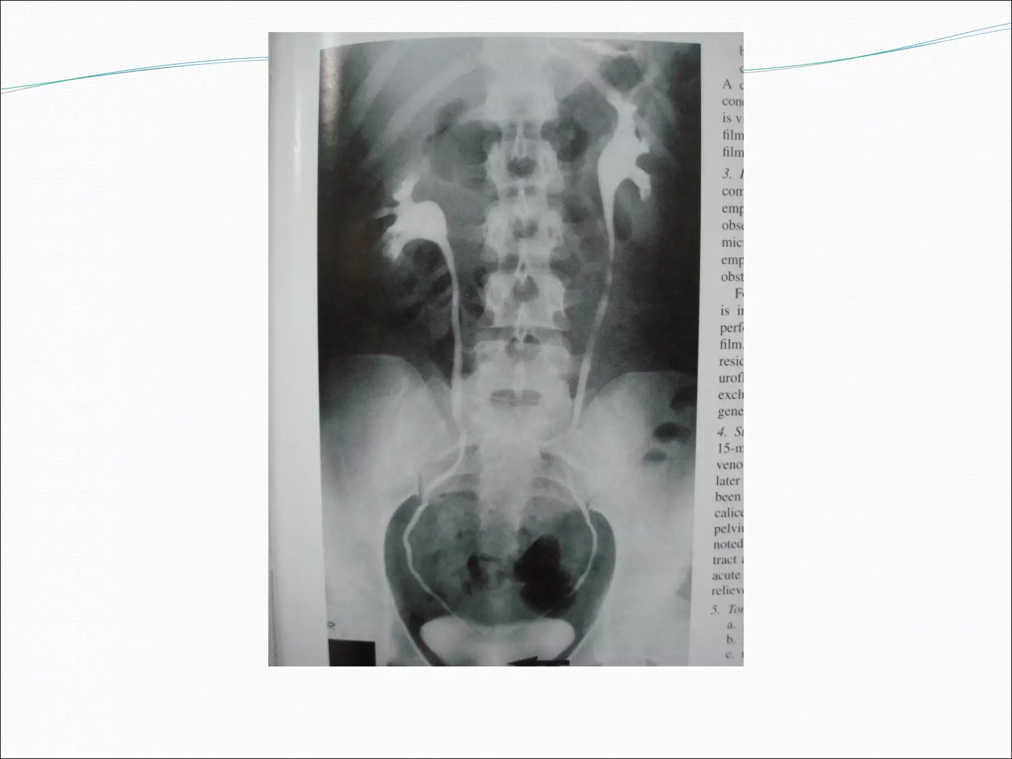 Intravenous urography (IVU) by Dr Bishnu Khatiwada, Conventional IVU ...