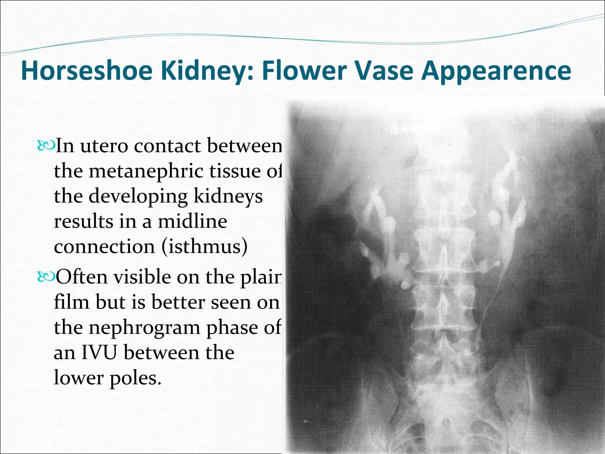 Intravenous urography (IVU) by Dr Bishnu Khatiwada, Conventional IVU ...