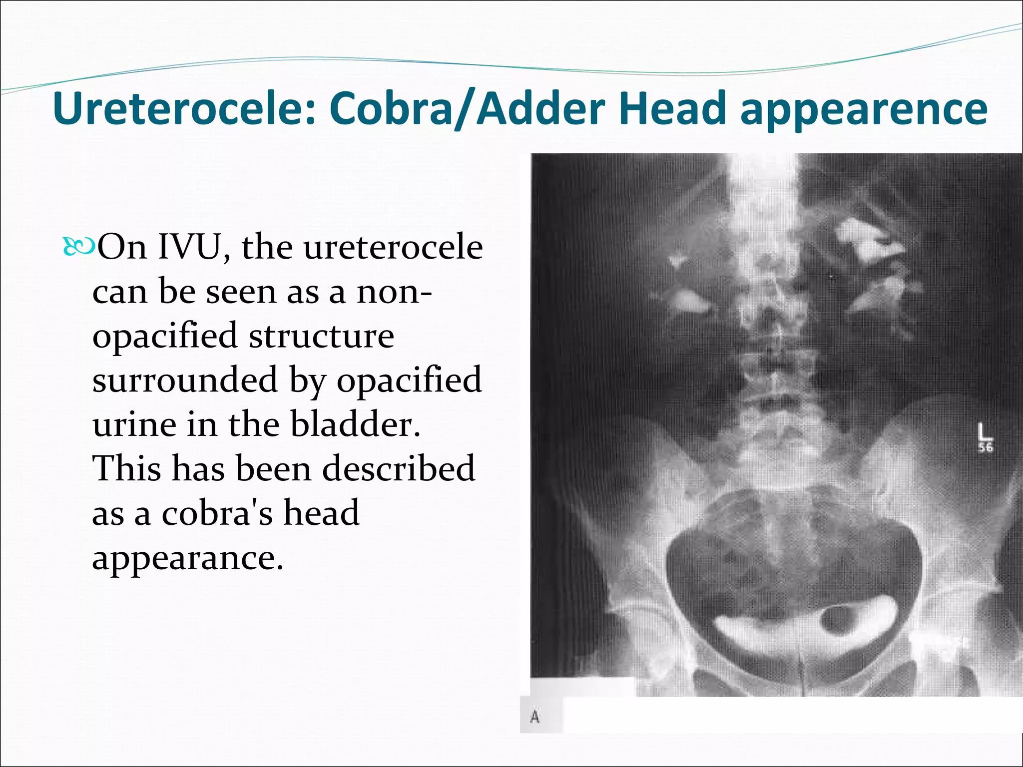 Intravenous urography (IVU) by Dr Bishnu Khatiwada, Conventional IVU ...