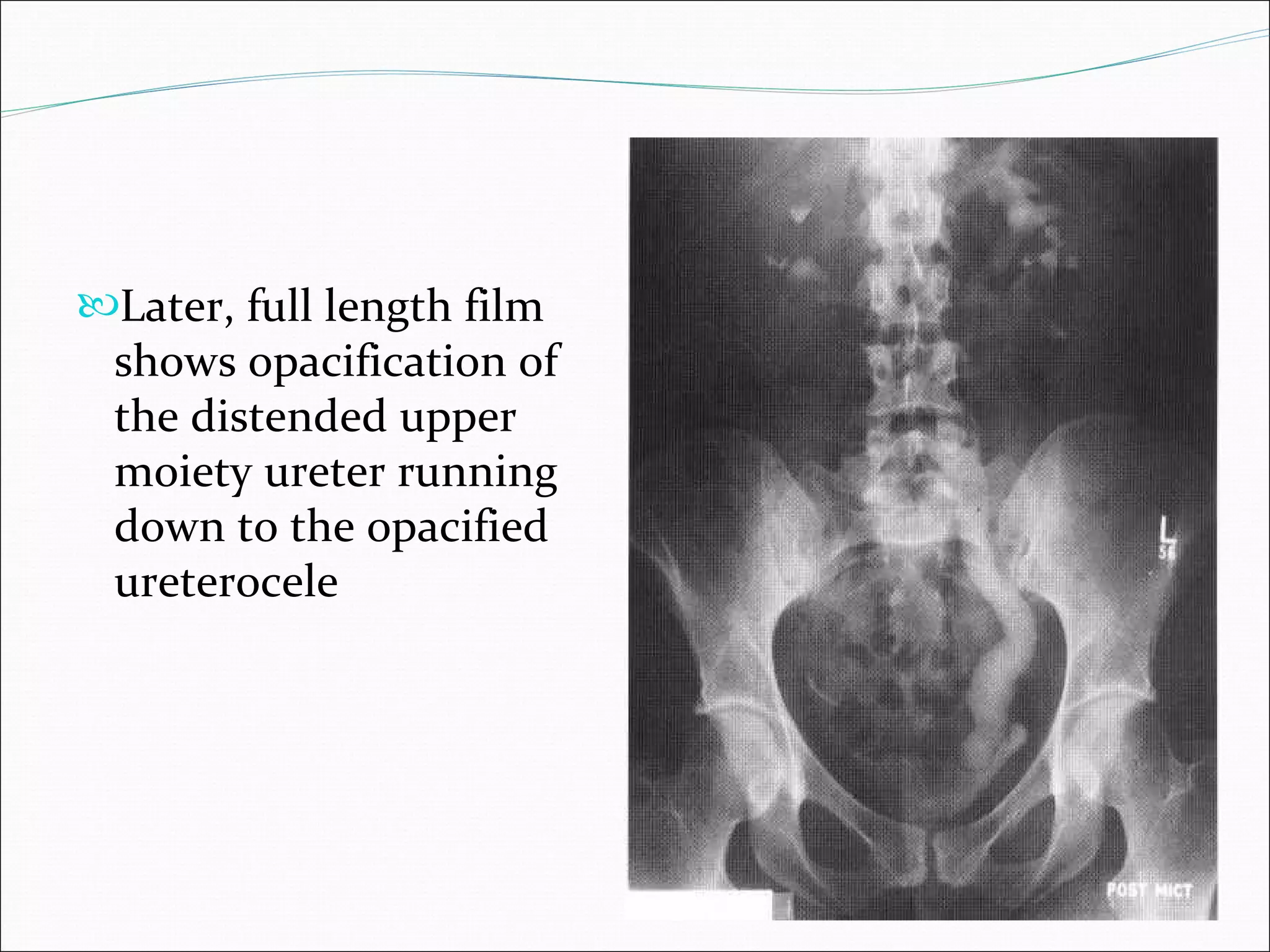Intravenous urography (IVU) by Dr Bishnu Khatiwada, Conventional IVU ...