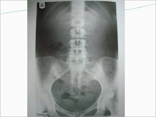 Intravenous urography (IVU) by Dr Bishnu Khatiwada, Conventional IVU ...