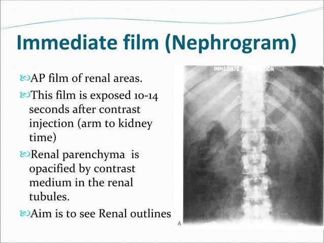 Intravenous urography (IVU) by Dr Bishnu Khatiwada, Conventional IVU ...