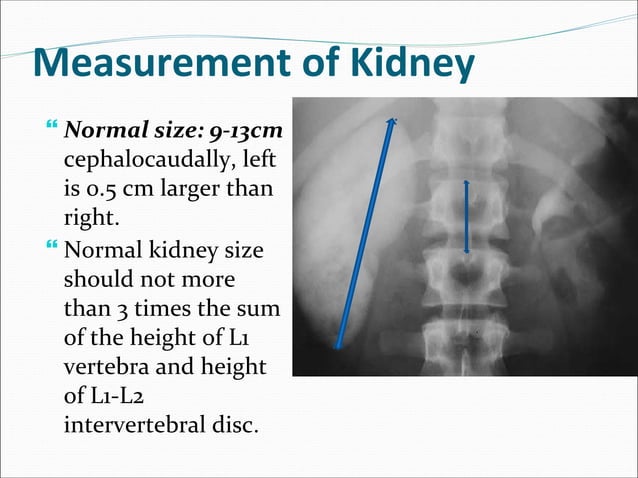 Intravenous urography (IVU) by Dr Bishnu Khatiwada, Conventional IVU ...