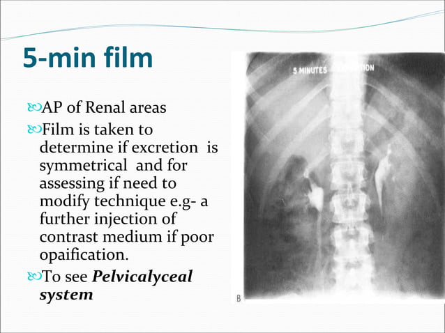 Intravenous urography (IVU) by Dr Bishnu Khatiwada, Conventional IVU ...