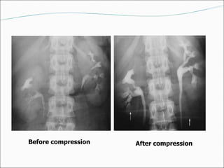 Intravenous urography (IVU) by Dr Bishnu Khatiwada, Conventional IVU ...