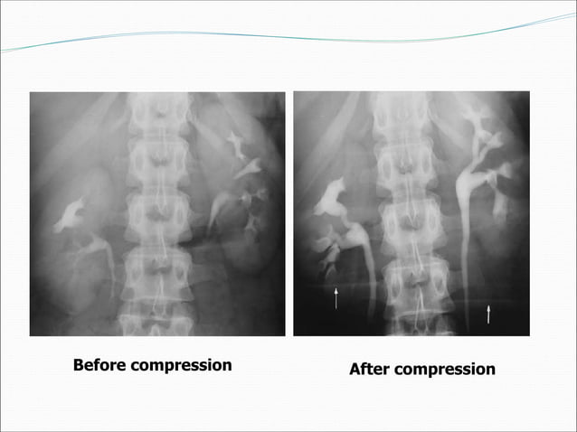 Intravenous urography (IVU) by Dr Bishnu Khatiwada, Conventional IVU ...