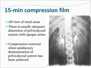 Intravenous urography (IVU) by Dr Bishnu Khatiwada, Conventional IVU ...