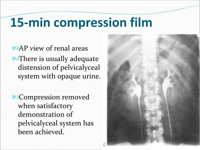 Intravenous urography (IVU) by Dr Bishnu Khatiwada, Conventional IVU ...
