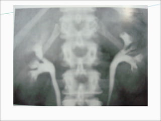 Intravenous urography (IVU) by Dr Bishnu Khatiwada, Conventional IVU ...