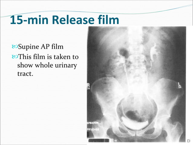 Intravenous urography (IVU) by Dr Bishnu Khatiwada, Conventional IVU ...