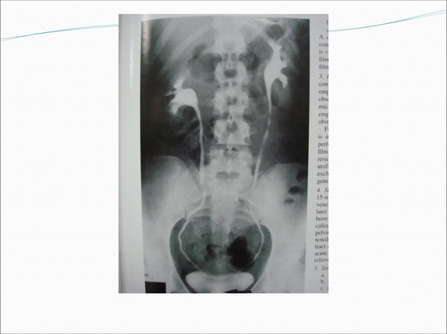 Intravenous urography (IVU) by Dr Bishnu Khatiwada, Conventional IVU, CT-IVU, MRI | PDF
