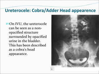 Intravenous urography (IVU) by Dr Bishnu Khatiwada, Conventional IVU ...