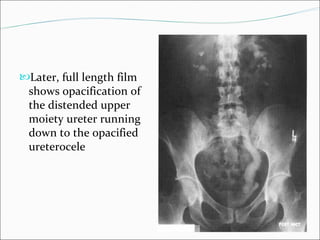 Intravenous urography (IVU) by Dr Bishnu Khatiwada, Conventional IVU ...