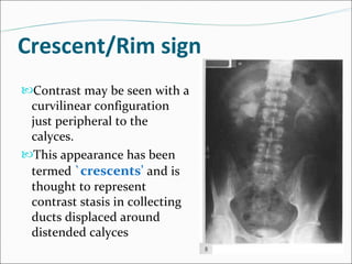 Intravenous urography (IVU) by Dr Bishnu Khatiwada, Conventional IVU ...