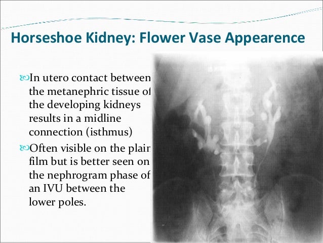 Intravenous Urography Radiology Reference Article Radiopaediaorg