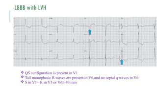 Intraventricular conduction block....... | PPTX
