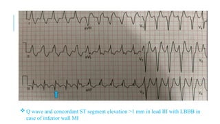 Intraventricular conduction block....... | PPTX