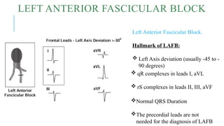 Intraventricular conduction block....... | PPTX