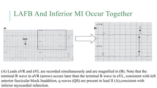 Intraventricular conduction block....... | PPTX