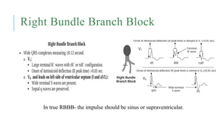 Intraventricular conduction block....... | PPTX