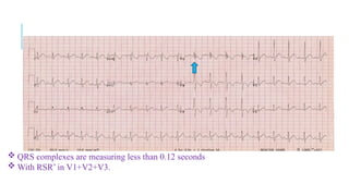 Intraventricular conduction block....... | PPTX