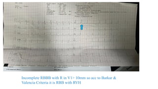 Intraventricular conduction block....... | PPTX